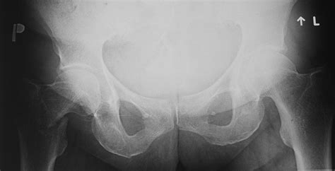 The Anteroposterior Pelvis Radiograph With A Basicervical Fracture Of