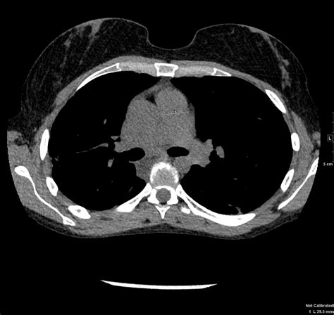 050lu Scleroderma Nsip Acro Osteolysis Lungs