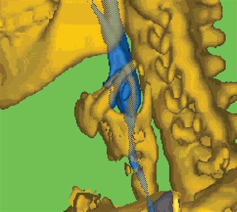 Figure 1 From The Use Of Three Dimensional Imaging In Orthodontics