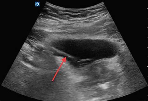 Ultrasound Guided Placement Of A Foley Catheter Using A Hydrophilic
