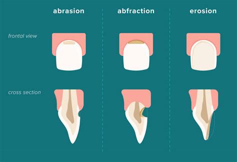 Best Tooth Erosion Treatment Tooth Abrasion Dental Treatment