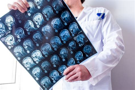 Día Mundial Del Neurólogo ¿por Qué Es El 29 De Noviembre