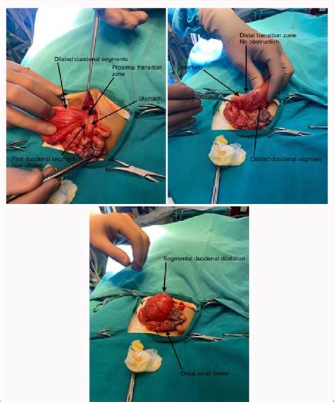 Intra Operative Findings Normal Stomach Pylorus And First Part Of The