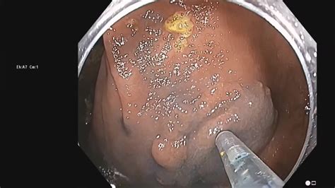 Gastroenterology Endoscopy Giendoscopy Gitwitter Gastroenterologist American Society For