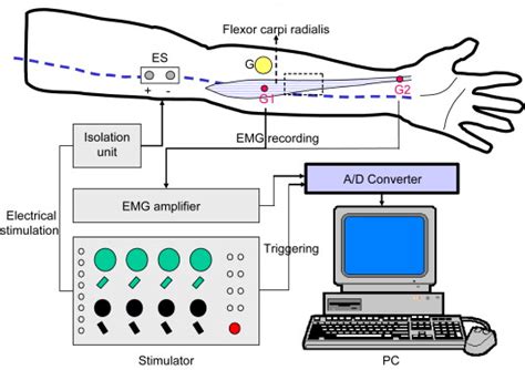 How Emg Sensors Improve Diagnosis Rehabilitation And Prosthetics