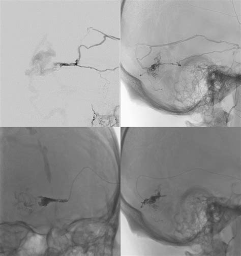 Complex Avm Davf Common Vein