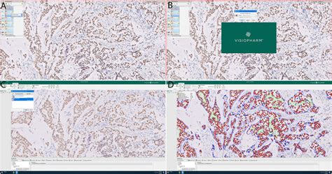 Automated Workflow Of Er Ihc Digital Imaging Analysis Dia Using