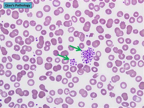 Qiaos Pathology Edta Induced Platelet Aggregation Flickr