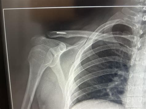 Ac Joint Separation Before Surgery And After 6 Weeks With