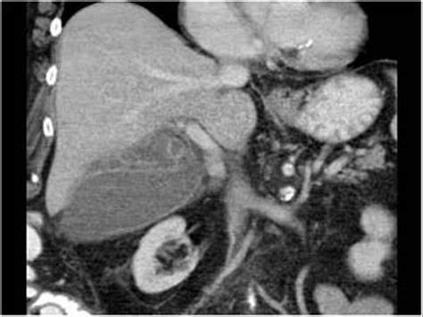 Abdomen And Retroperitoneum 12 Gallbladder And Bile Ducts Case 12