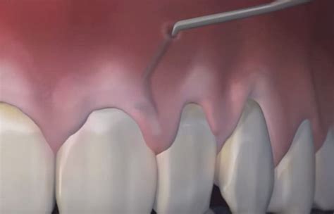 Pinhole® Surgical Technique Salem Nh Dr Charles Burliss