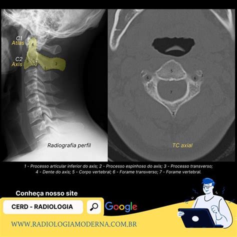 Anatomia radiográfica básica da C2 Radiologia Medicina Radiologia