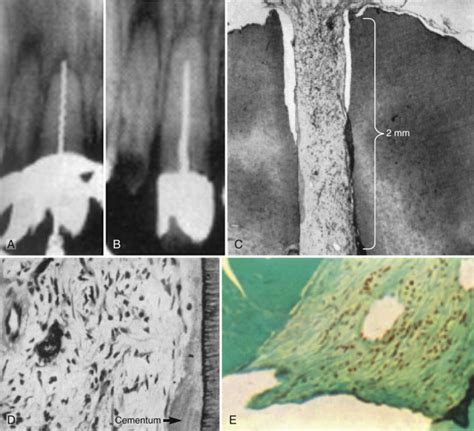 Regenerative Endodontics Pocket Dentistry
