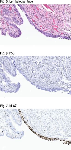 Ancillary Tests In Gynecologic Pathology—what And Why Cap Today