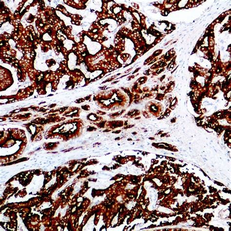 What Does Asbestosis Look Like On A Ct Scan