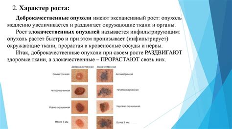 Доброкачественные и злокачественные новообразования общие черты и