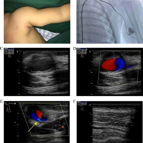 Preoperative Examination Of The Patient A A Mass Can Be Seen Under The