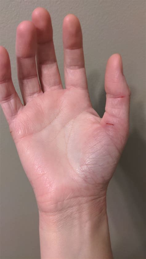 Possible Early Symptoms R Scleroderma