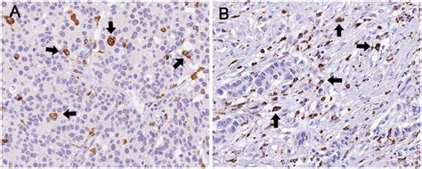 Infiltration Of Cd68 Tumor Associated Macrophages Tams In Distinct