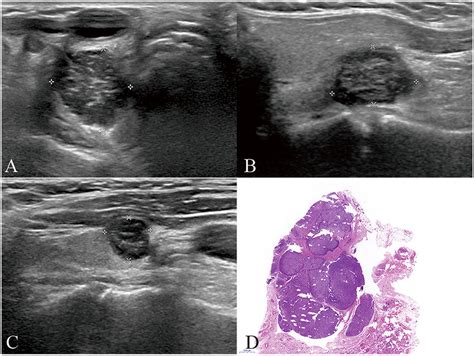 Gray Scale Sonogram A B And C Showing Intralesional Septa Like