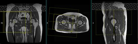 Mri Arthrogram Hip Protocol And Planning Indications For Mri