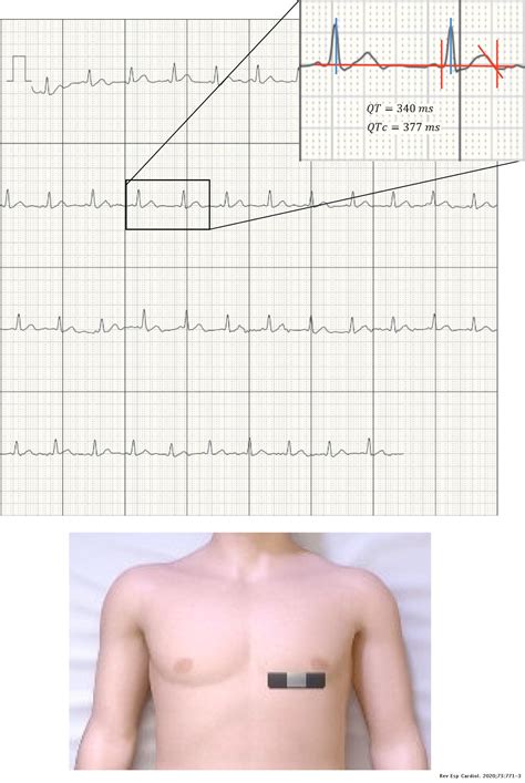 Electrocardiographicqt Interval Monitoring With A Portable Device In Hospitalized Patients With