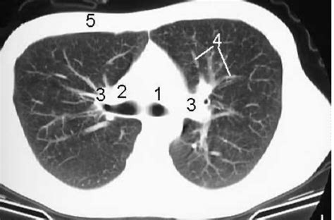 Diagram Of Chest Ct Lung Fields Quizlet