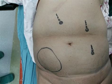 青海大学附属医院腹腔镜外科率先应用TAR Transversus Abdominus Muscle Release腹横肌分离松解技术