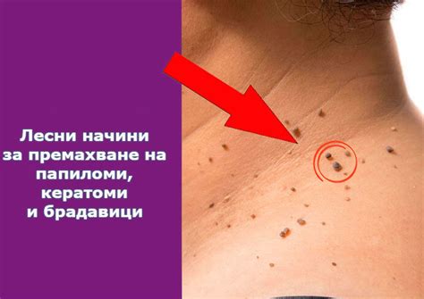 Лесни начини за премахване на папиломи кератоми и брадавици