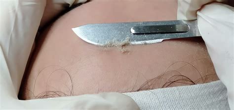 جلسات الديرما بلاننج Sou Center For Skinandhair Care