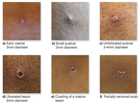 How High Is The Risk Of Catching Mpox And How Can I Protect Myself
