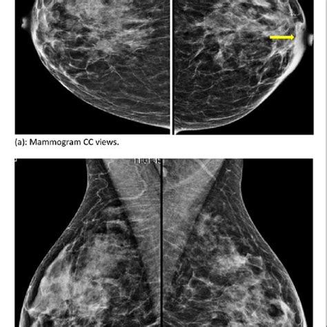 A Mammogram Cc Views B Mammogram Mlo View Focal High Density Area In Download Scientific
