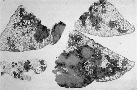 Pulmonary Vasculitis Thoracic Key