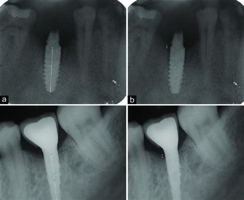 Bone Loss Calculated By Linear Measurements Of Implant And Crestal Bone