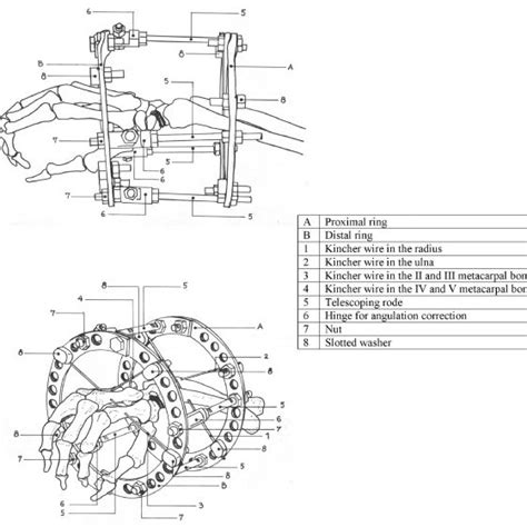 Schernbergs Scaphoid Classification 32 I Proximal Pole Ii Iii