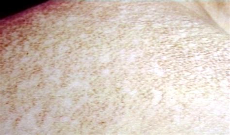 Crest Scleroderma Scalp