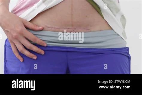 Cesarean Section Scar Stock Videos And Footage Hd And 4k Video Clips