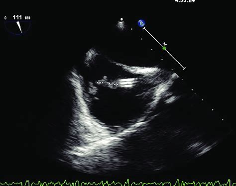 Transoesophageal Echocardiogram Views A Small Thrombus Seen Attached Download Scientific