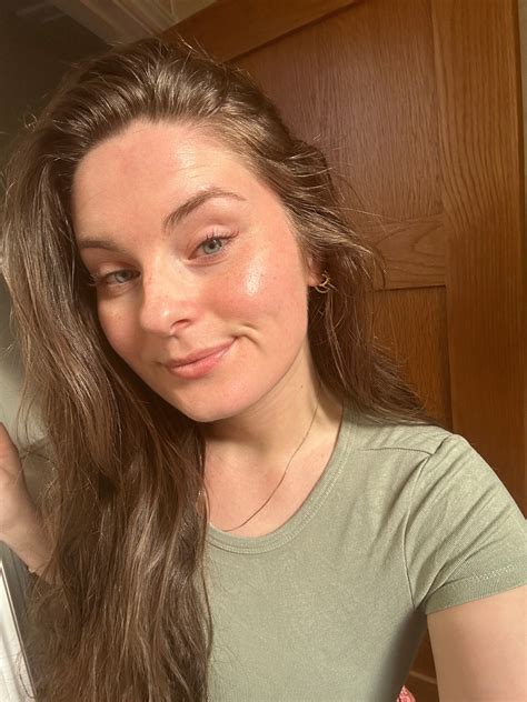Heres How I Successfully Got Rid Of My Perioral Dermatitis