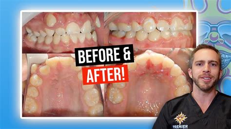 Braces Before And After Crowding With Missing Teeth Youtube