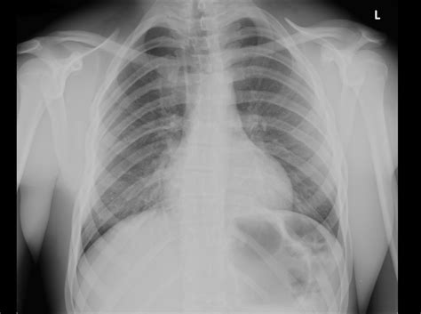 The Daily Educational Pearl Posterior Sternoclavicular Dislocation Emergucate