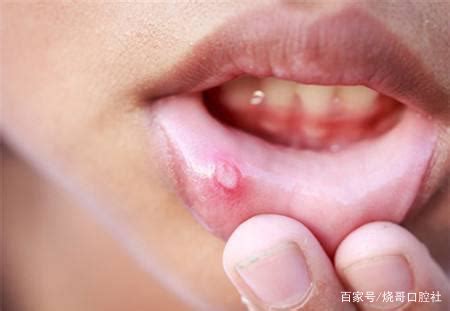 口腔溃疡会引起扁桃体发炎是怎么回事 治疗
