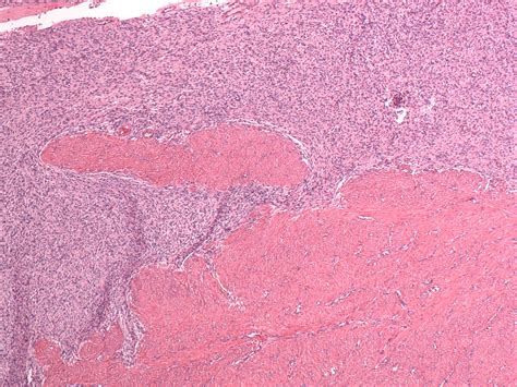 Endometrial Stromal Sarcoma Wikipedia