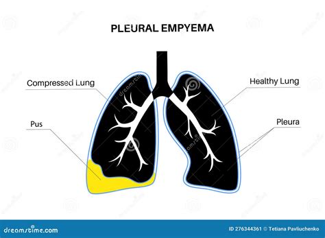 Pyothorax Pleural Empyema Stock Vector Illustration Of Bacterial 276344361