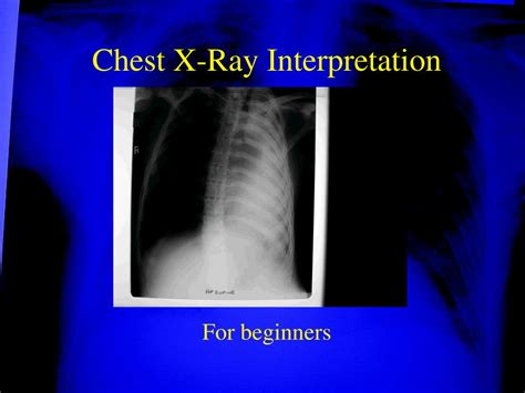 Ppt Chest X Ray Interpretation Powerpoint Presentation Free Download