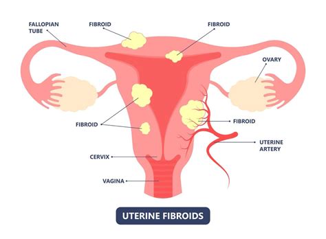 What Is The Difference Between Fibroids And Ovarian Cysts AFC