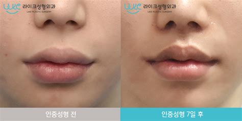 라이크성형외과 전후사진