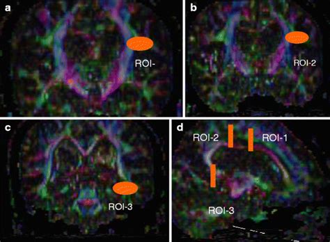 Assessment Of Arcuate Fasciculus With Diffusion Tensor Tractography May