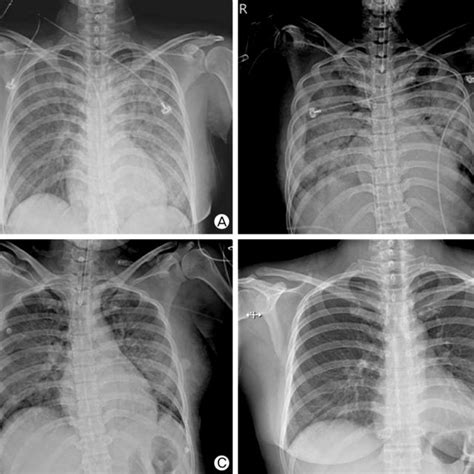 A A Chest X Ray At Presentation Shows Diffuse Bilateral Infiltration