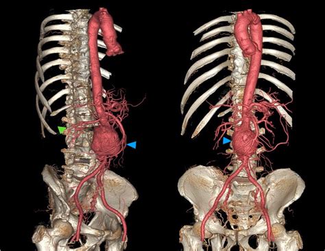 Mycotic Aortic Aneurysm